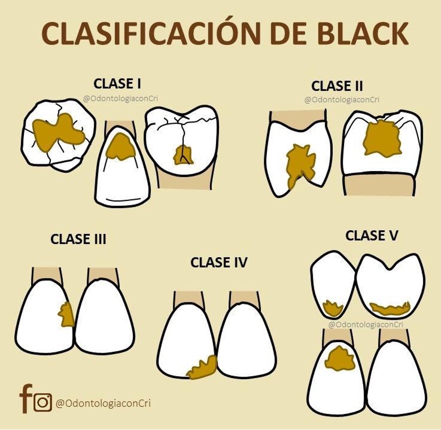TIPOS DE CARIES DENTALES